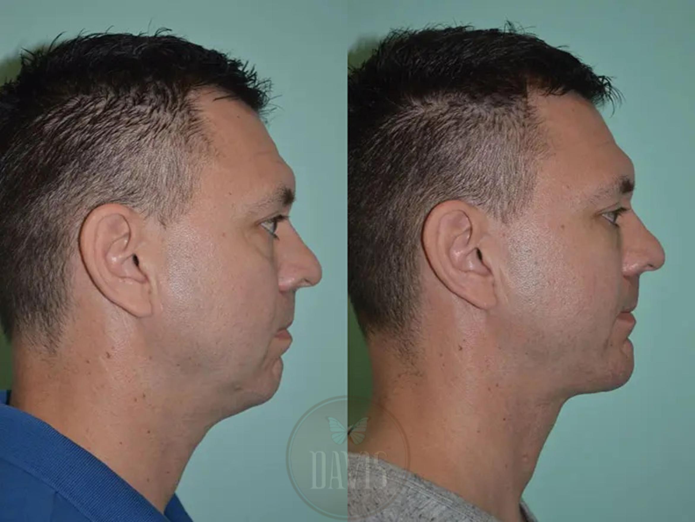 Chin Augmentation Before and After Pictures Case 1148 | Tampa, FL ...