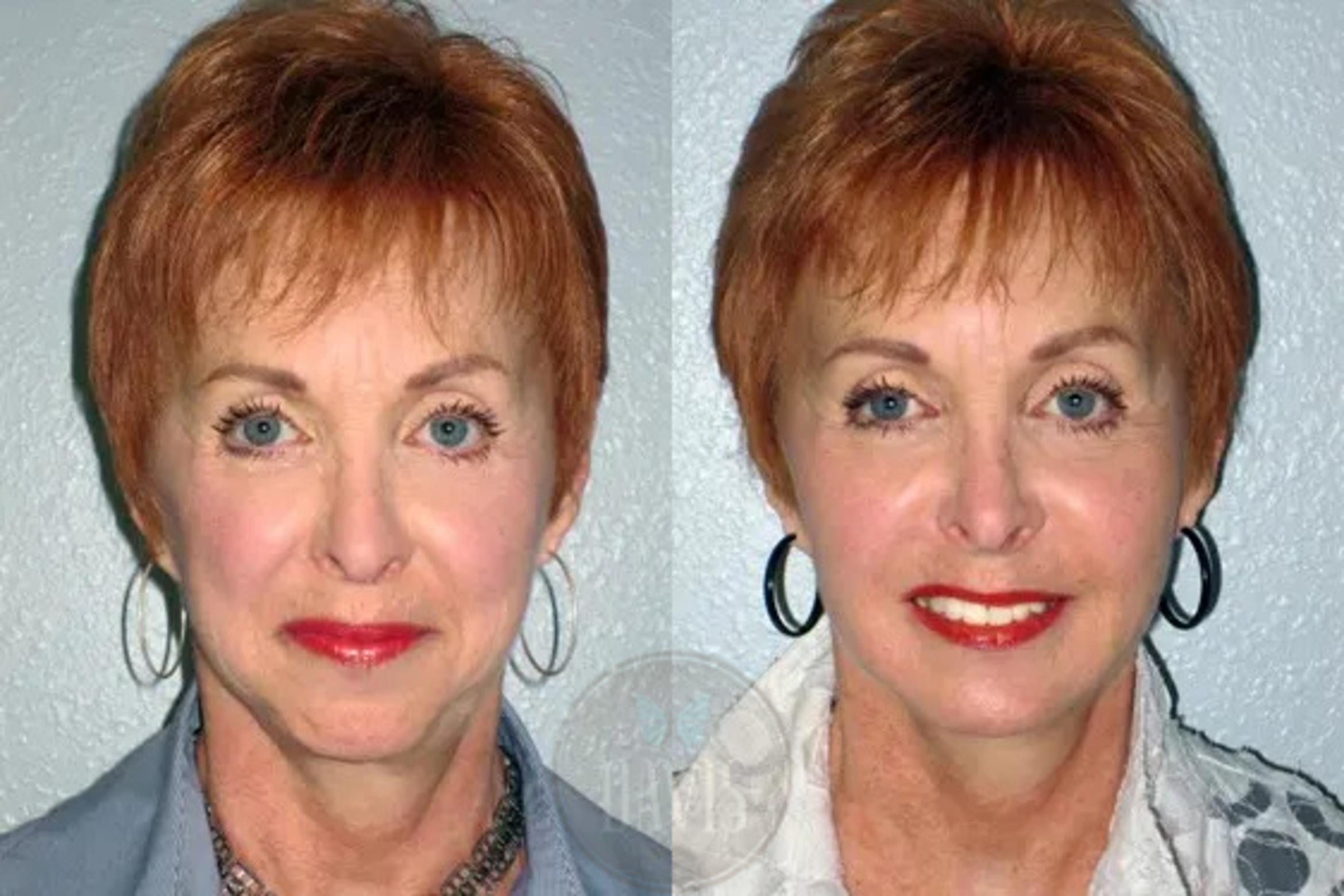Malar/Cheek Augmentation Before and After Pictures Case 1045 | Tampa ...