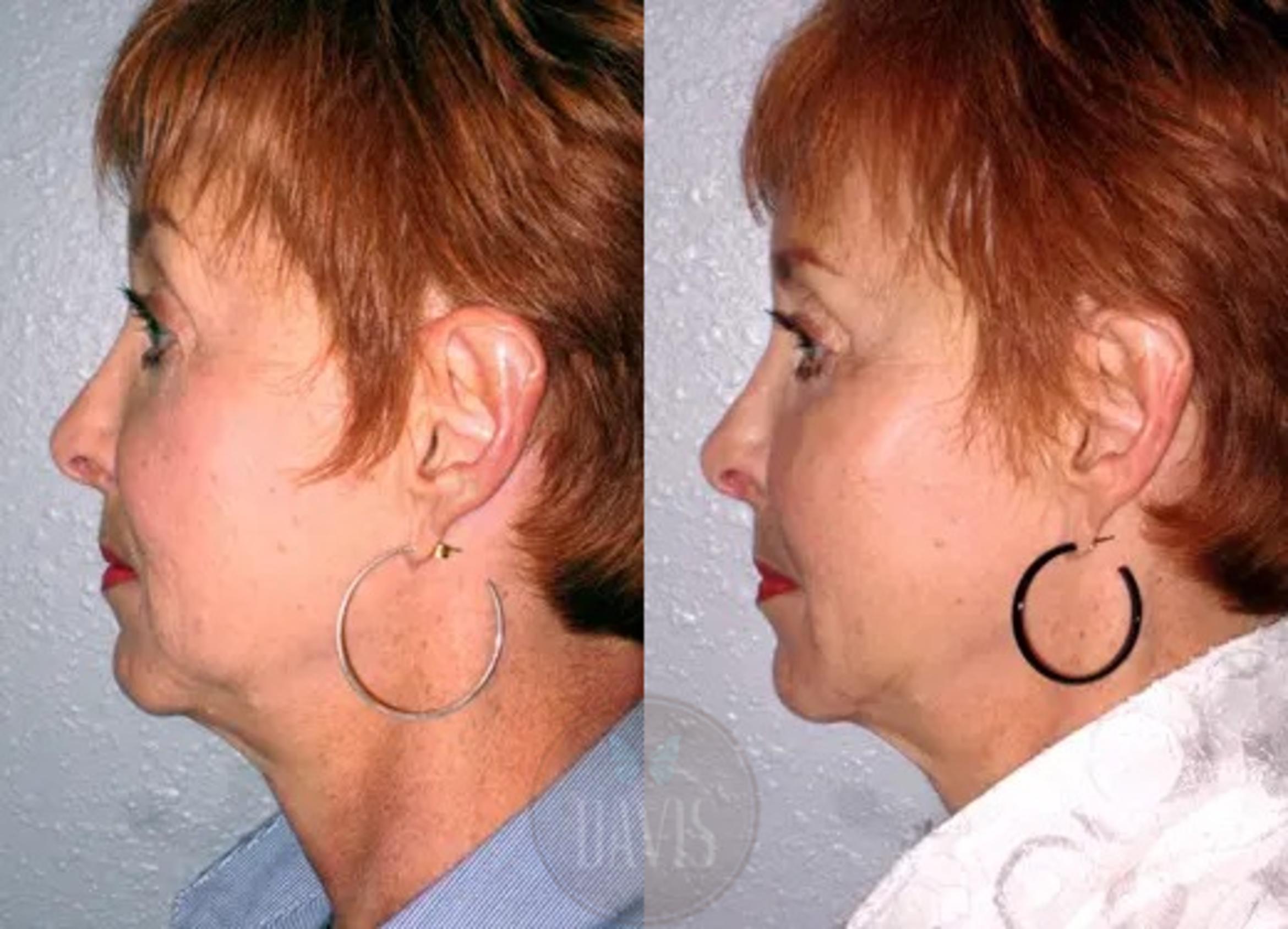 Malar/Cheek Augmentation Before and After Pictures Case 1045 | Tampa ...